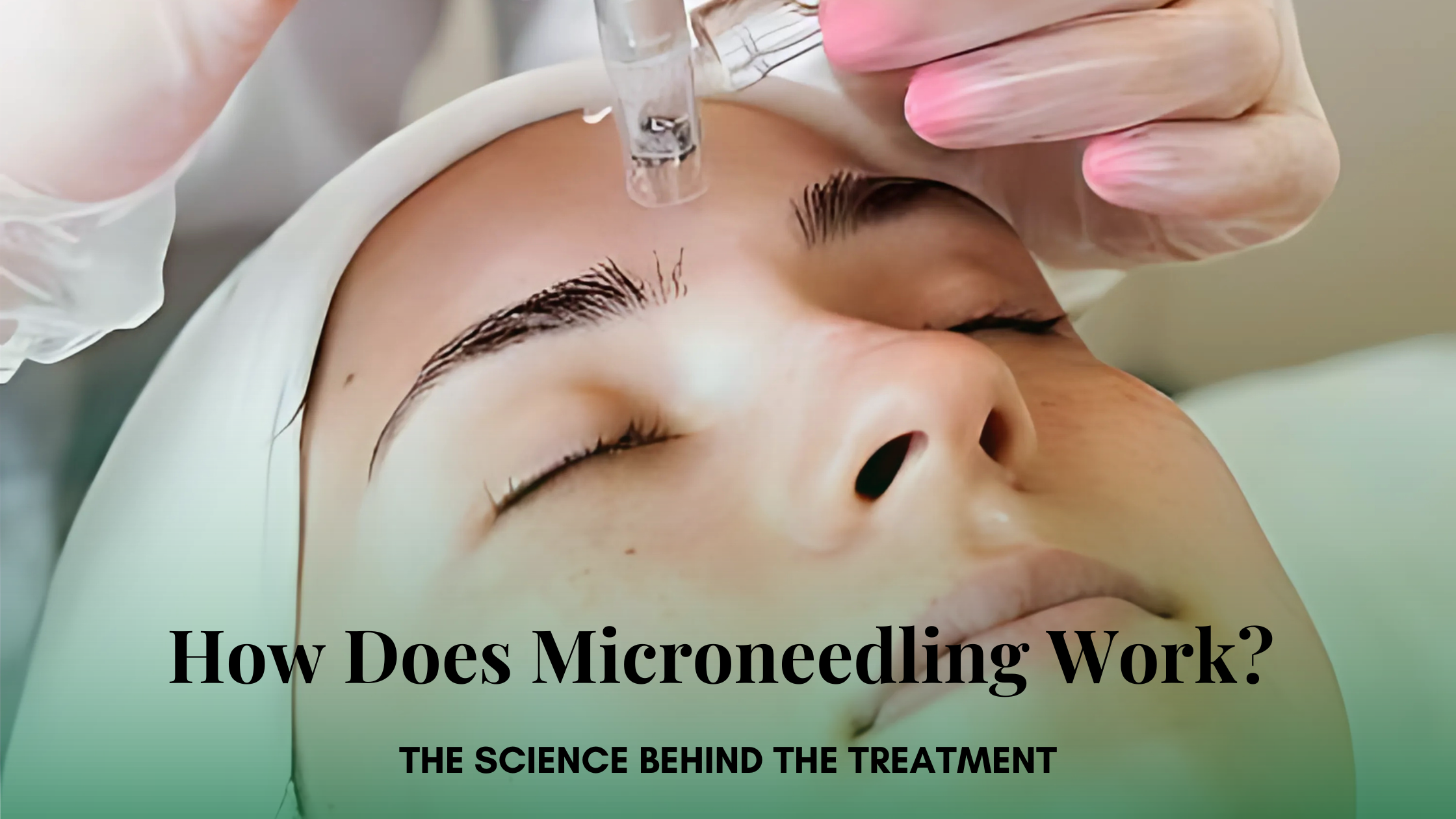 How Does Microneedling Work? The Science Behind the Treatment - Kamya ...